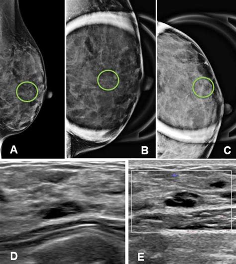 Simple Cyst Clustered Microcysts Complicated Cyst Radiology Ucla Health