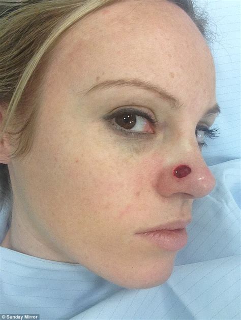 Basal Cell Carcinoma Mohs Surgery Pictures Nose At Julie Lundy Blog