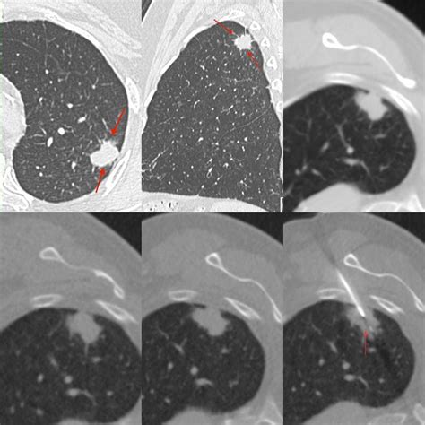 Spiculated Lung Nodule Only On Sagittal And The Power Of Lateral Decubitus Ref India