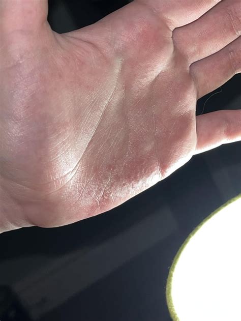 What Is This Bumpy Rash On My Hands Rmedicaladvice