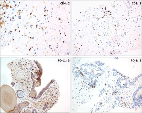 Representative Ihc Staining Of Cd4 Cd8 And Pd L1 In Prostate Biopsy