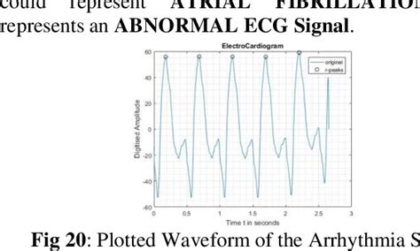 Figure 20 From Classification Of Arrhythmia From Ecg Signals Using Matlab Semantic Scholar