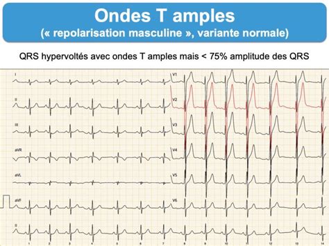 Onde T Ample E Cardiogram