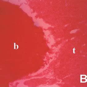 Microphotographs Of BSP In Situ Hybridization In The Metastatic Tumor Download Scientific