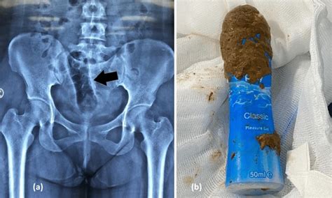 A Pelvic Radiograph Revealed A Well Defined Radiolucent Structure In