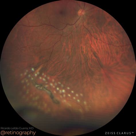 Retinography Sharing And Learning On Linkedin Peripheral Degeneration