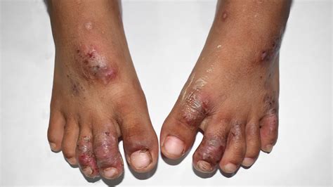 Scabies Bumps On Feet