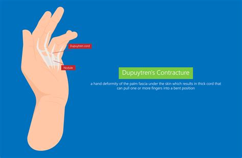 Injection Vs Fasciotomy For Dupuytrens Contracture