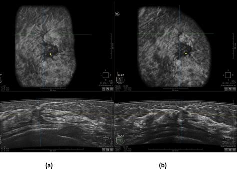 Introduction Of Automated Breast Ultrasound As An Additional Screening