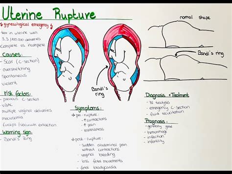 Uterine Rupture Signs And Symptoms Obstetric Emergency Definition