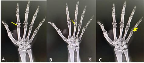Morphological And Topographic Analysis Of The Sesamoid Bones Of The