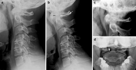 Cervical Spine In Rheumatoid Arthritis Image My Xxx Hot Girl