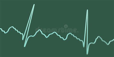 Ecg In Atrial Flutter An Abnormal Heart Rhythm Characterized By Rapid Regular Contractions Of
