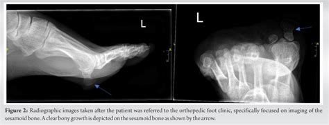 A Rare Case Of Exostosis Of The Medial Sesamoid Bone Journal Of