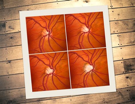 Optic Nerve Cupping Progression Moran Core Glaucomatous Cupping