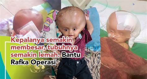 Campaign Kepalanya Semakin Membesar Tubuhnya Semakin Lemah Bantu