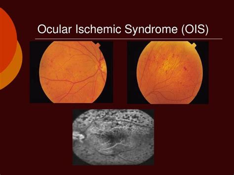 Ocular Ischemic Syndrome Ocular Ischemic Syndrome Pdf Qkdlxk