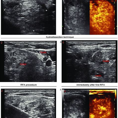 A 55 Year Old Woman With A Large Solid Thyroid Nodule Extending To