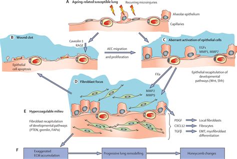 Idiopathic Pulmonary Fibrosis The Lancet