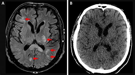 Ante Mortem And Post Mortem Radiology A Image Taken From Mri Brain Download Scientific