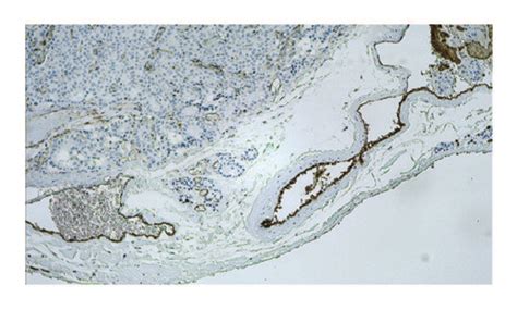 Parathyroid Adenoma A The Patient Underwent Minimally Invasive Download Scientific Diagram