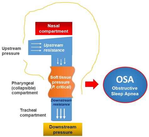 Comorbid Obstructive Lung Disease And Obstructive Sleep Apnea Aco Download Scientific Diagram