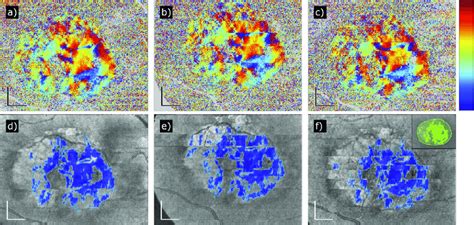 Repeatability Of Fibrosis Segmentation Three Measurements Of The Same