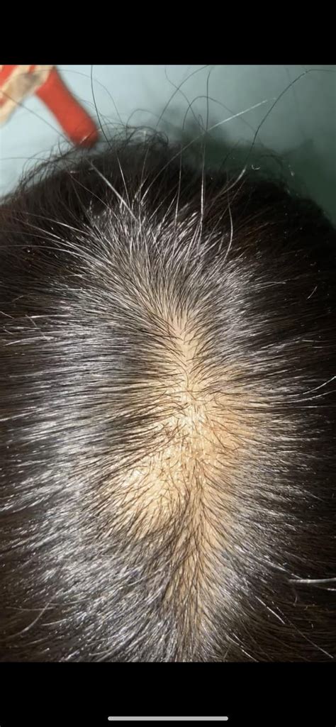 Scalp Spot Hair Regrowth Rtrichotillomania