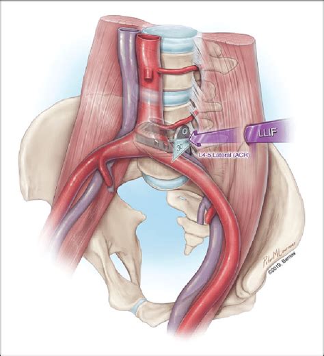 Illustration Of The Transpsoas Approach To The Anterior Column Download Scientific Diagram