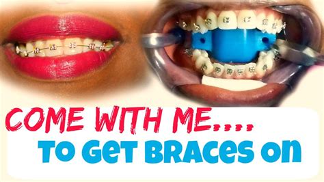 Getting Braces Vlog Youtube