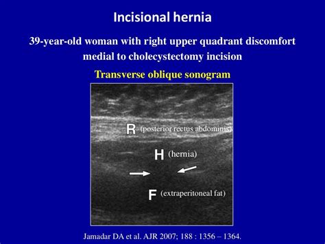Ultrasound Of The Abdominal Wall Hernias