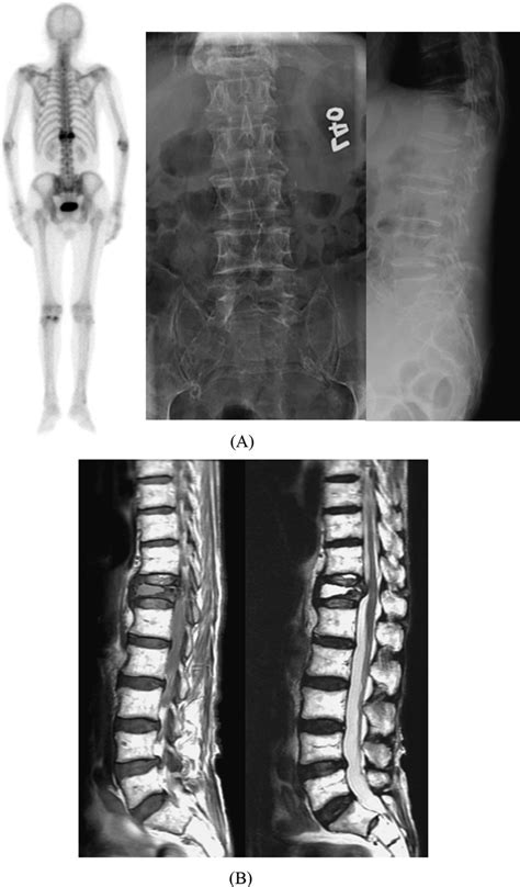 A L1 Cleft Sign On Plain Film And Hot Uptake On Bone Scan B Low Download Scientific