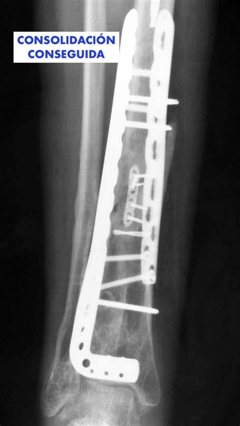 ¿qué Es La Pseudoartrosis De Tibia Los Mejores Especialistas En