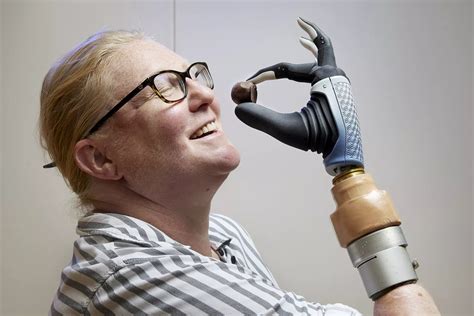 Woman Becomes First Person To Be Fitted For Bionic Hand That Integrates