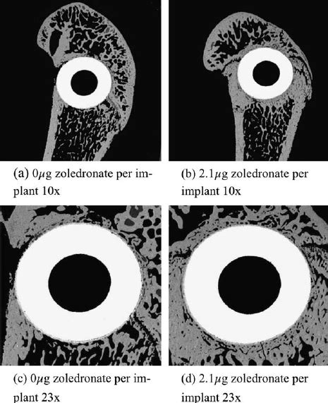 Sem Pictures Of Two Implanted Condyles At Magnification Of 10 Â And 23
