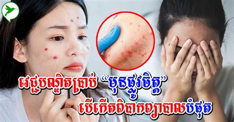 វេជ្ជបណ្ឌិតជំនាញប្រាប់ឈ្មោះ មុន១ប្រភេទកើតលើមុខ ពិបាកព្យាបាលបំផុតគឺមុនផ្លូវចិត្ត