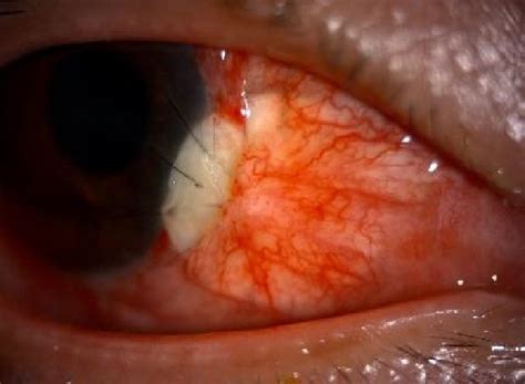 A Presence 2 Area Of Scleral Thinning At Inferonasal Quadrant B