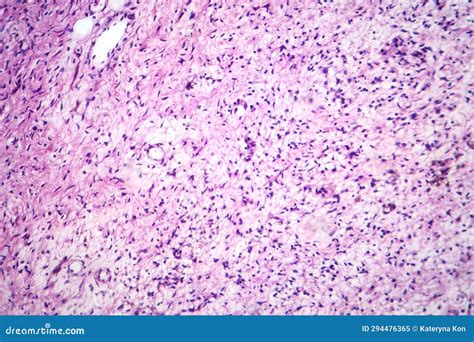 A Neurofibroma Tissue Sample In Neurofibromatosis Genetic Disease