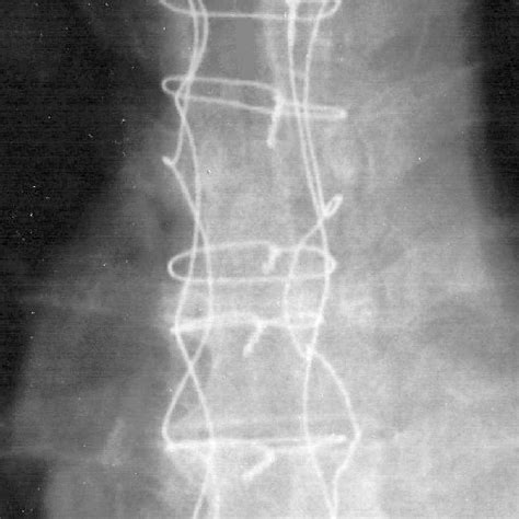 Figure Of Eight Closure Of Median Sternotomy Download Scientific Diagram