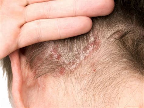 Treat Scalp Scabs With These Remedies