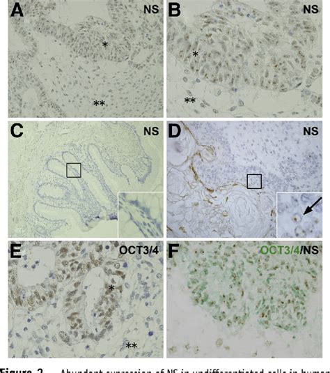 Figure 2 From Tumorigenesis And Neoplastic Progression Abundant Nucleostemin Expression Supports