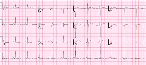 Dyspnea And Convex St Elevation Marked Lvh With Bedside Echos Dr