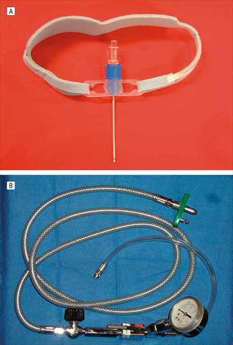 Anesthesia Jet Ventilation At Keith Katz Blog