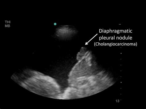 thoracentesis pleural biopsy and thoracic ultrasound pulmonology