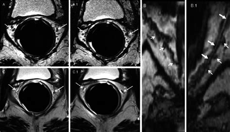 A 64 Year Old Man After Radical Retropubic Prostatectomy Preoperative Download Scientific