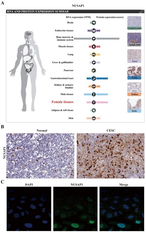 Expression Of Nusap1 At Mrna And Protein Levels In Cervical Cancer