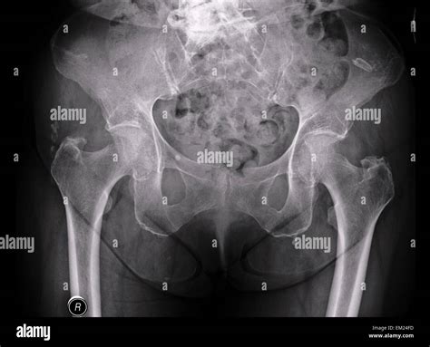 Osteoporotic Bone X Ray