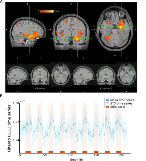 Results Of Glm Analysis On A Single Subject 307 During An Es Fmri Run