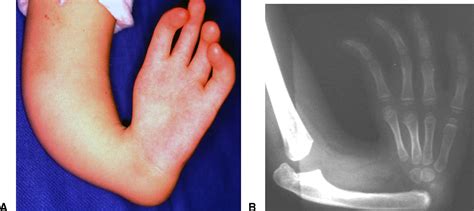 Congenital Longitudinal Deficiency Journal Of Hand Surgery