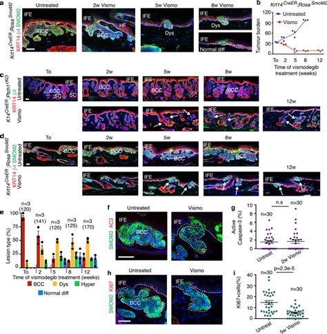 Vismodegib Leads To Tumour Shrinkage And Emergence Of Download